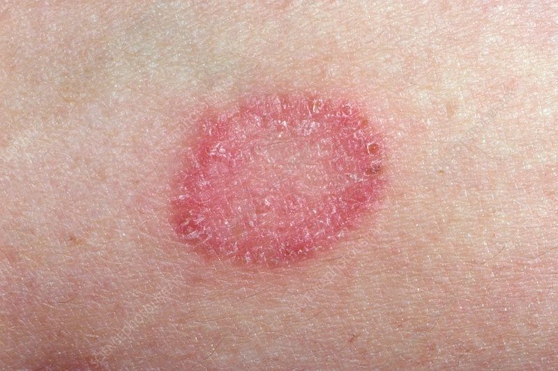 Ringworm Infection: A case of successful cure using YPV protocols