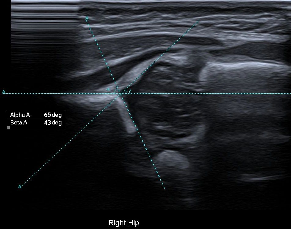 Neonatal Hip Ultrasound Screening