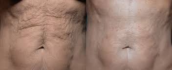 Ignite RF Consult (In-Person Assessment Required)