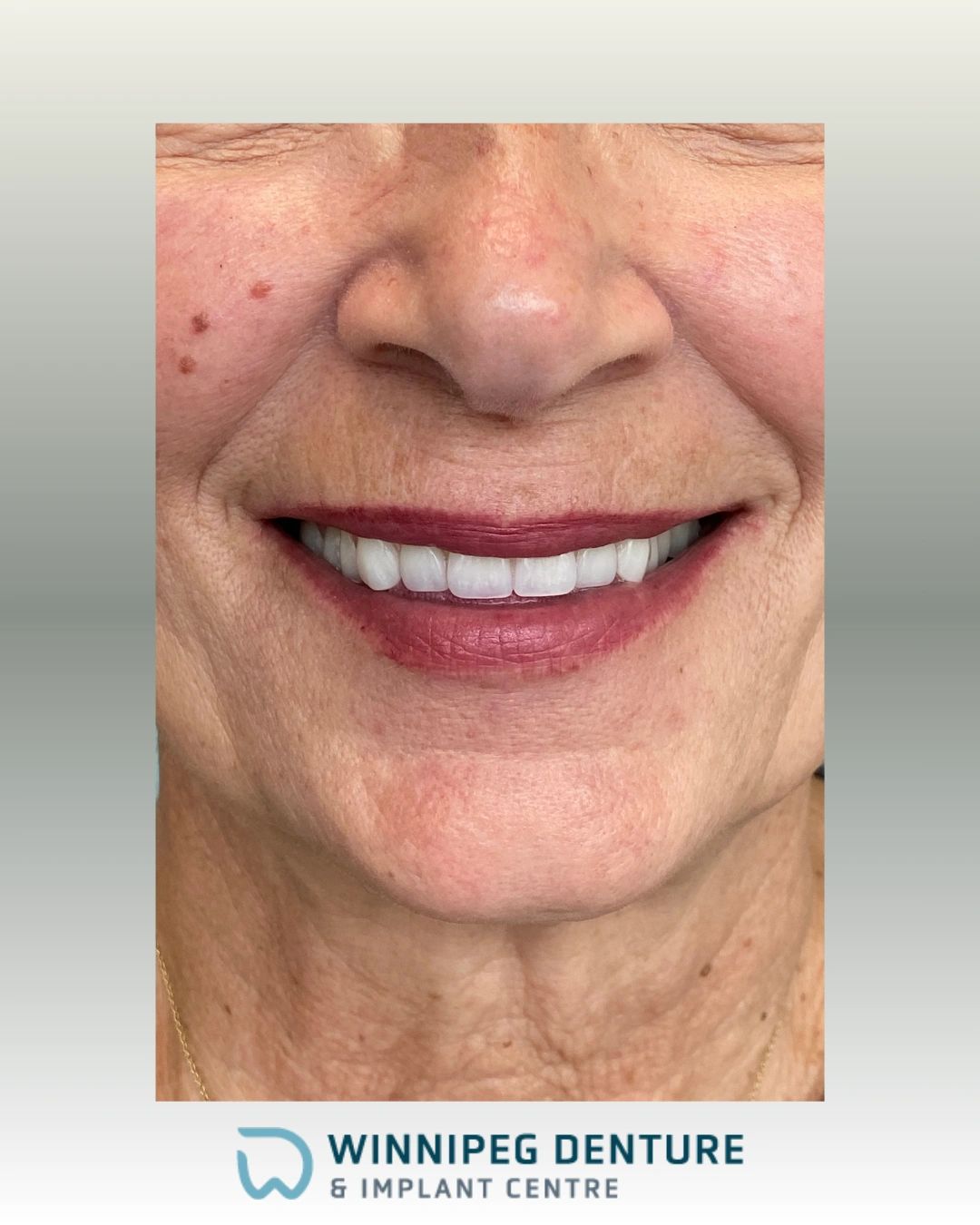 The Benefits of Implant-Supported Dentures