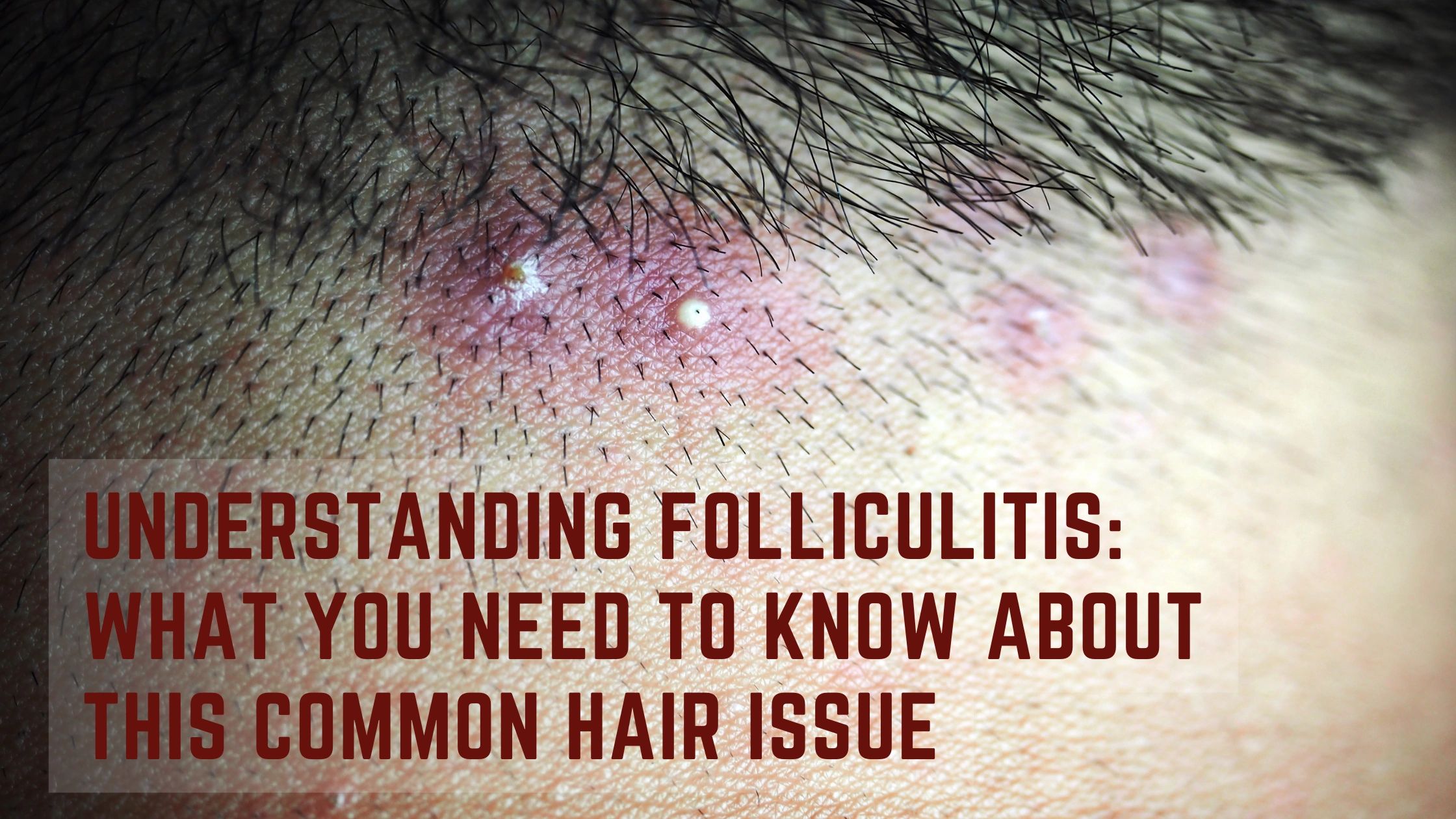 Understanding Folliculitis: What You Need to Know About It