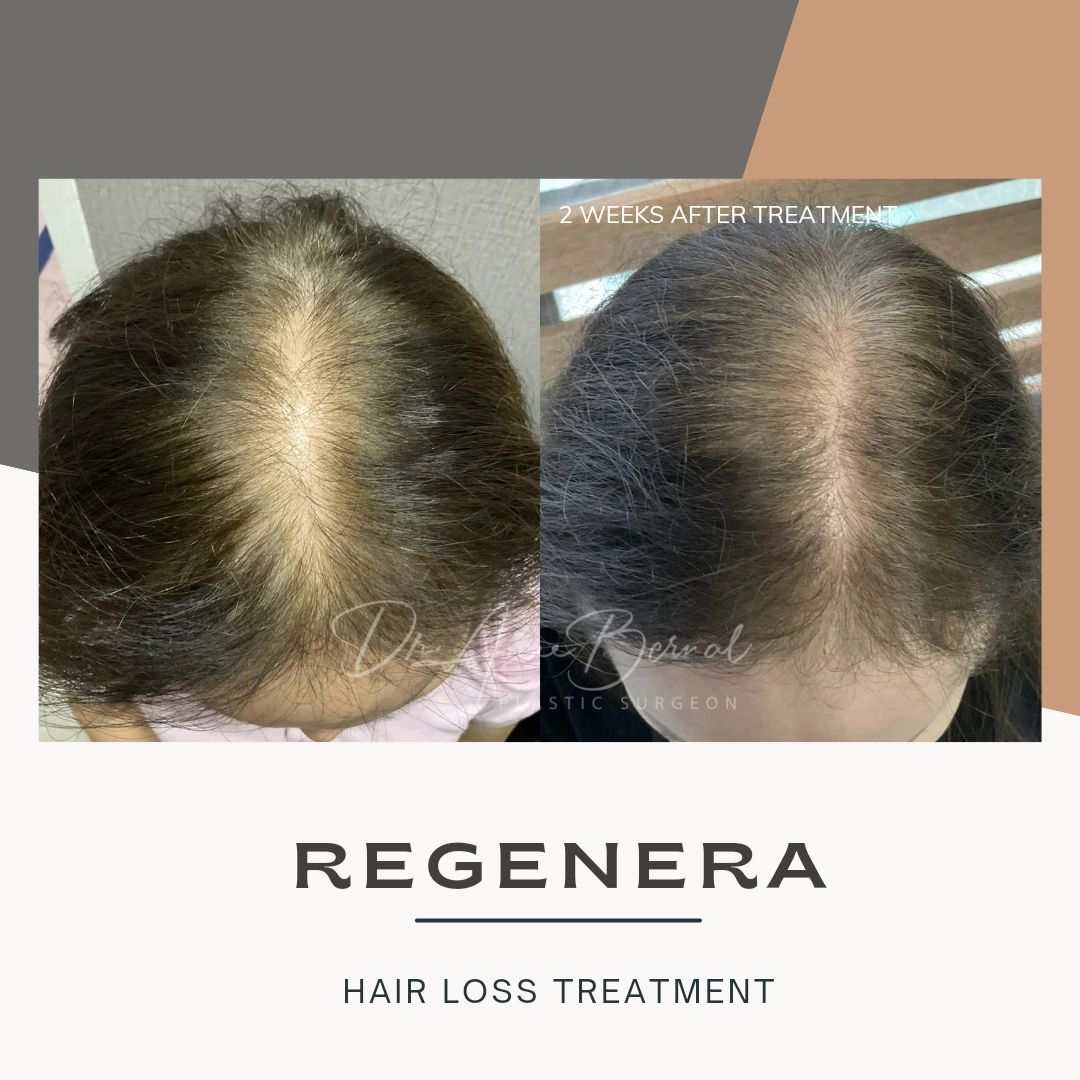 Regenera Stem Cell Hair Loss Treatment