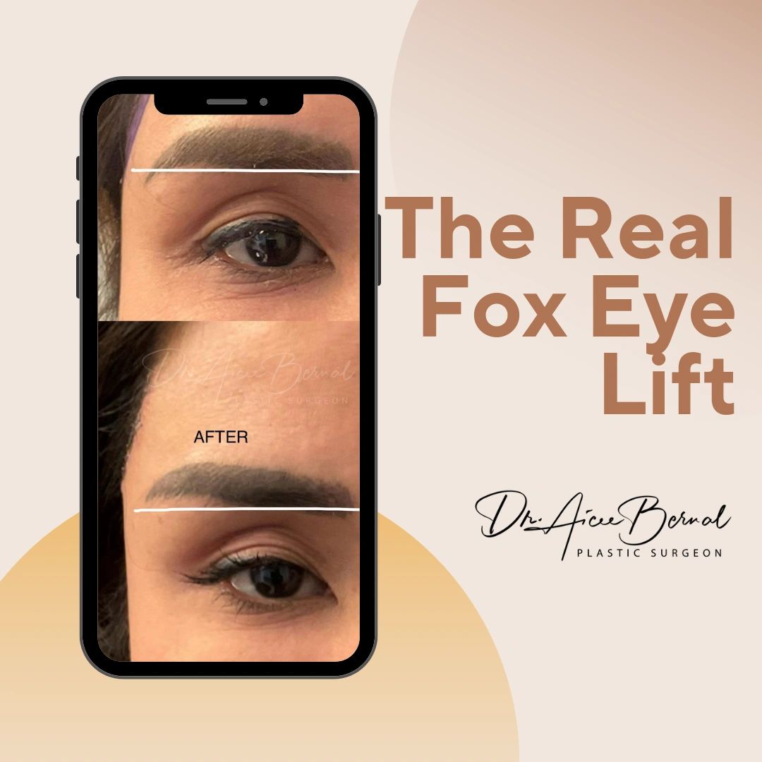 How to get the real FoxEye Lift?