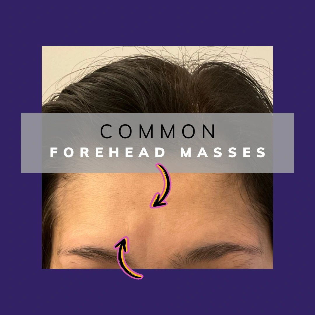 Common Forehead Lumps