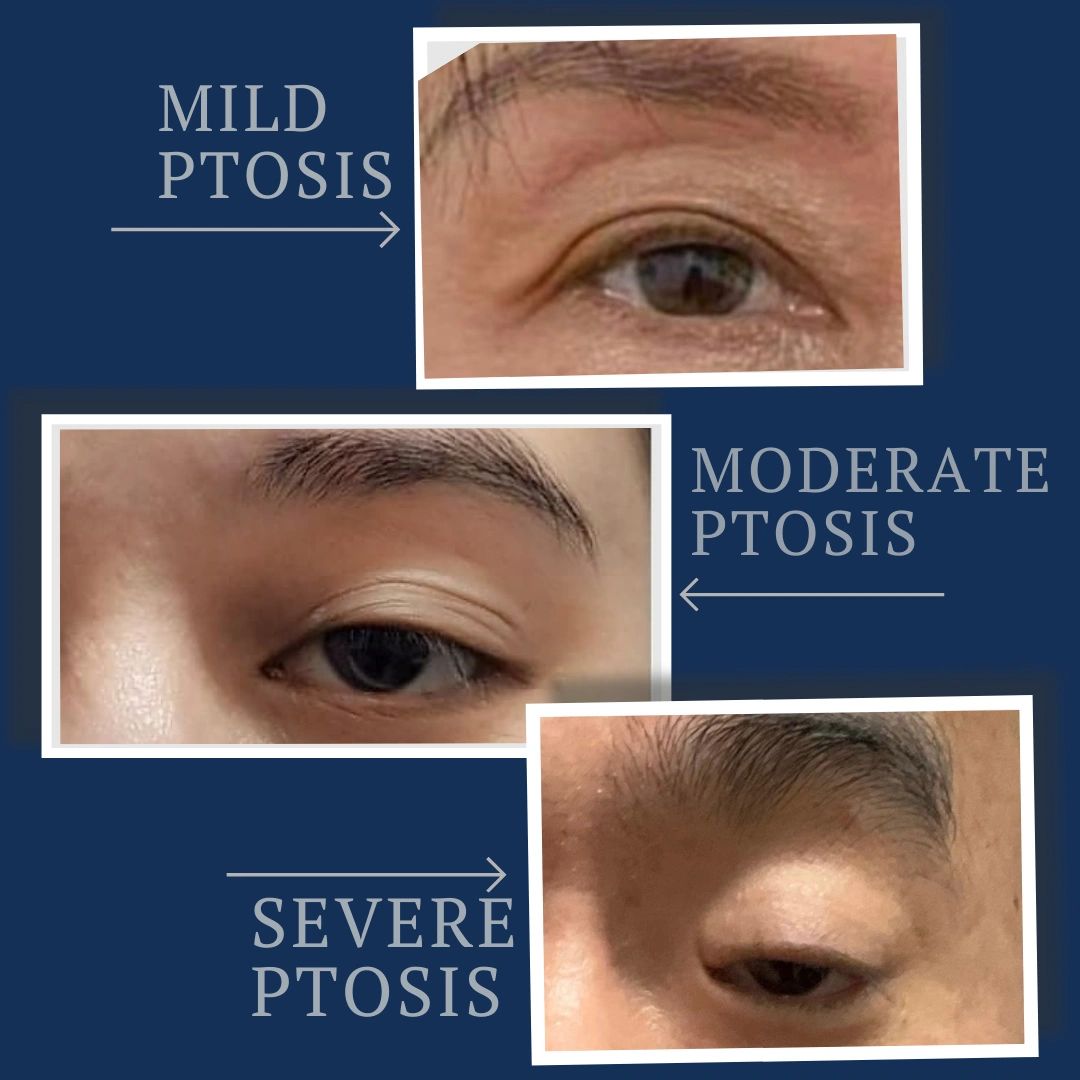 Types of Eyelid Ptosis