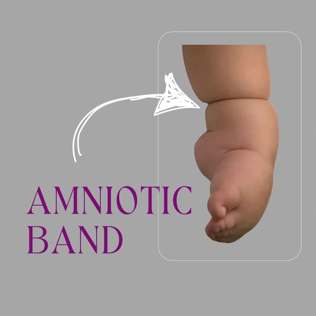 Amniotic Band Syndrome