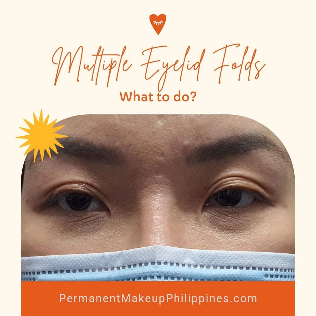 How to treat Multiple Eyelid Folds