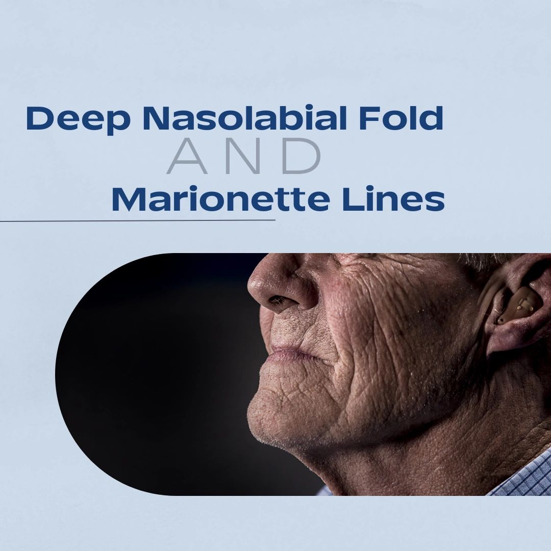 Solution to Deep Nasolabial Fold and Marionette Lines