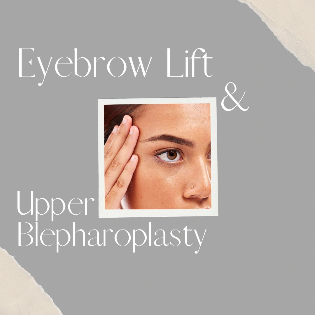 Eyebrow Lift and Upper Blepharoplasty for tired droopy eyelids