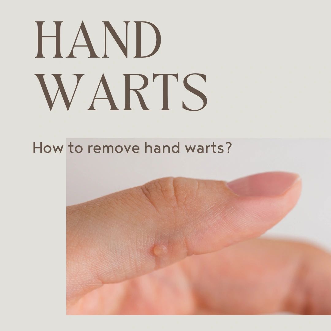 How to remove hand warts?