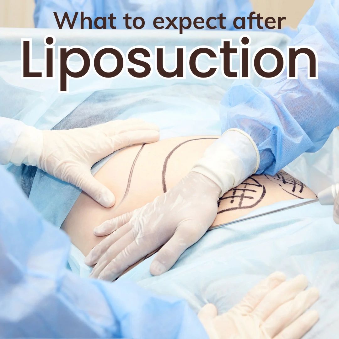 What to expect after Liposuction