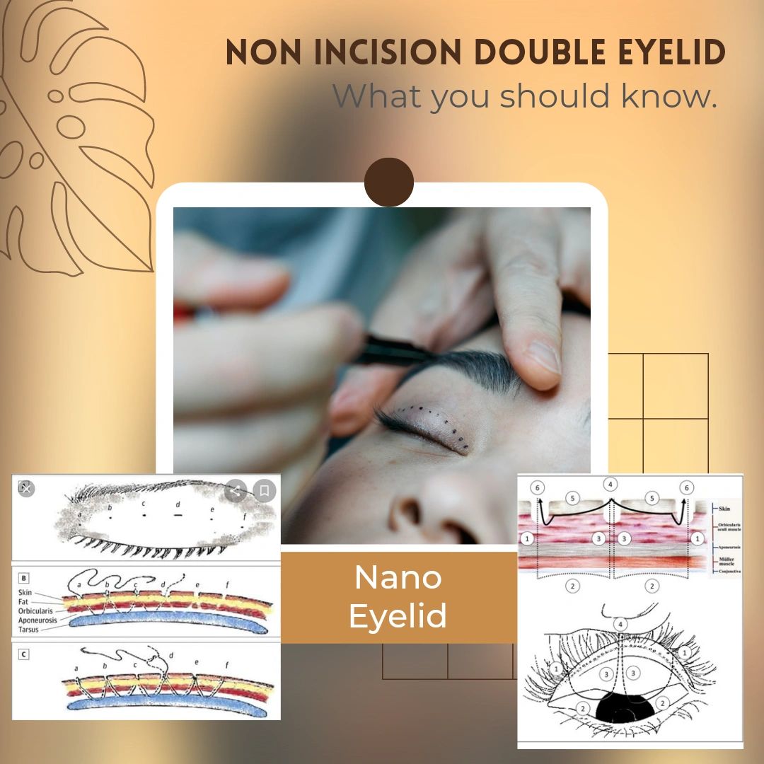 Possible Complications of Nano Eyelid Procedure