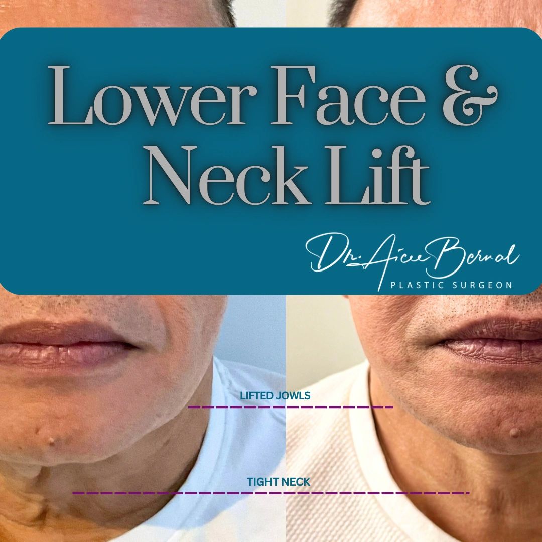 How to tighten sagging neck skin?
