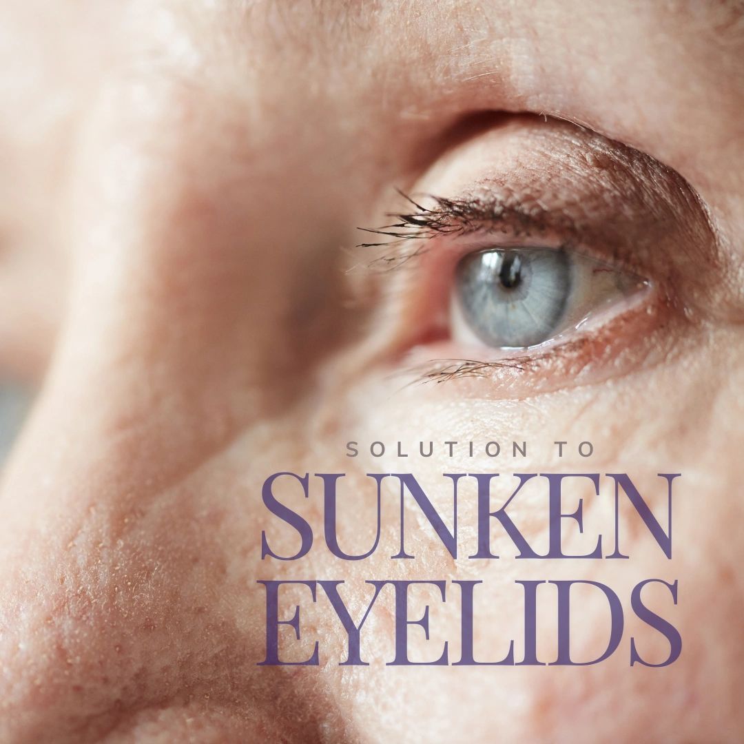 How to treat Sunken Upper Eyelids?