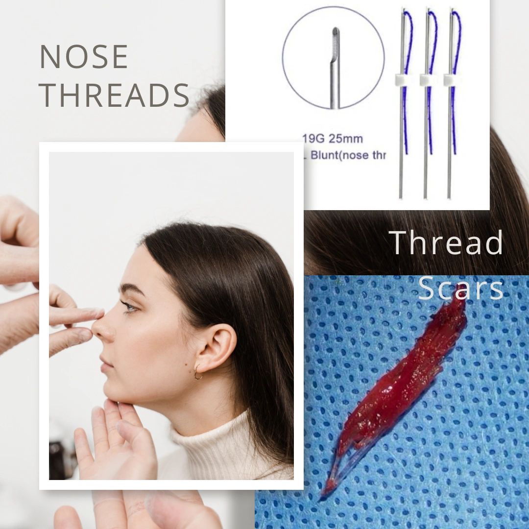 Hiko Nose Lift Side Effect