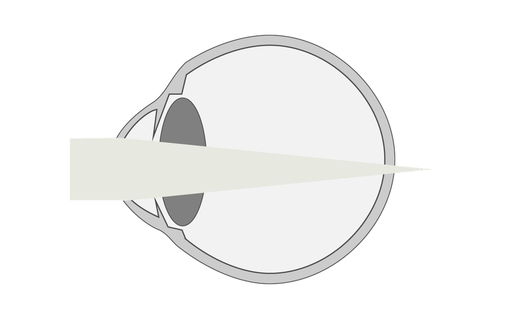 Hyperopia | EZIO Opticians