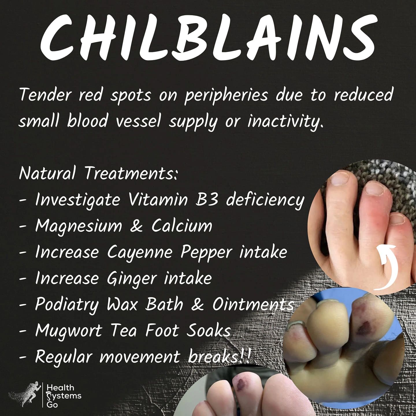List 96+ Pictures Photos Of Chilblains On Toes Superb