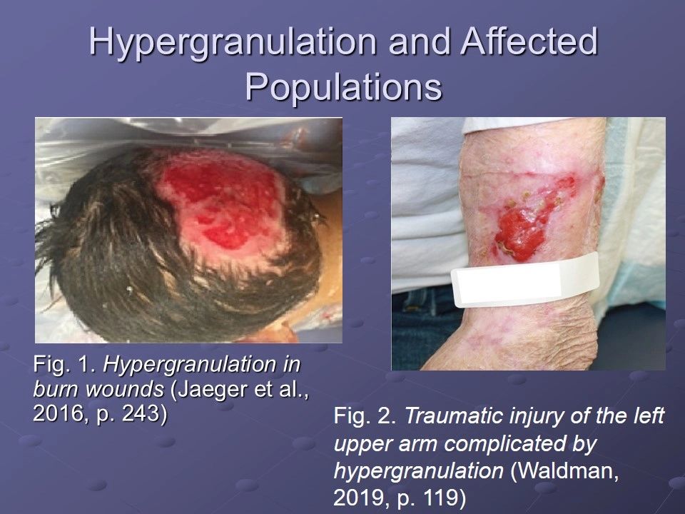 Understanding Hypergranulation: A Clinical Perspective