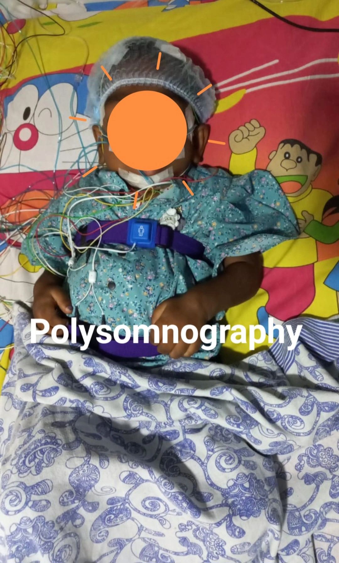 POLYSOMNOGRAPHY (SLEEP STUDY)