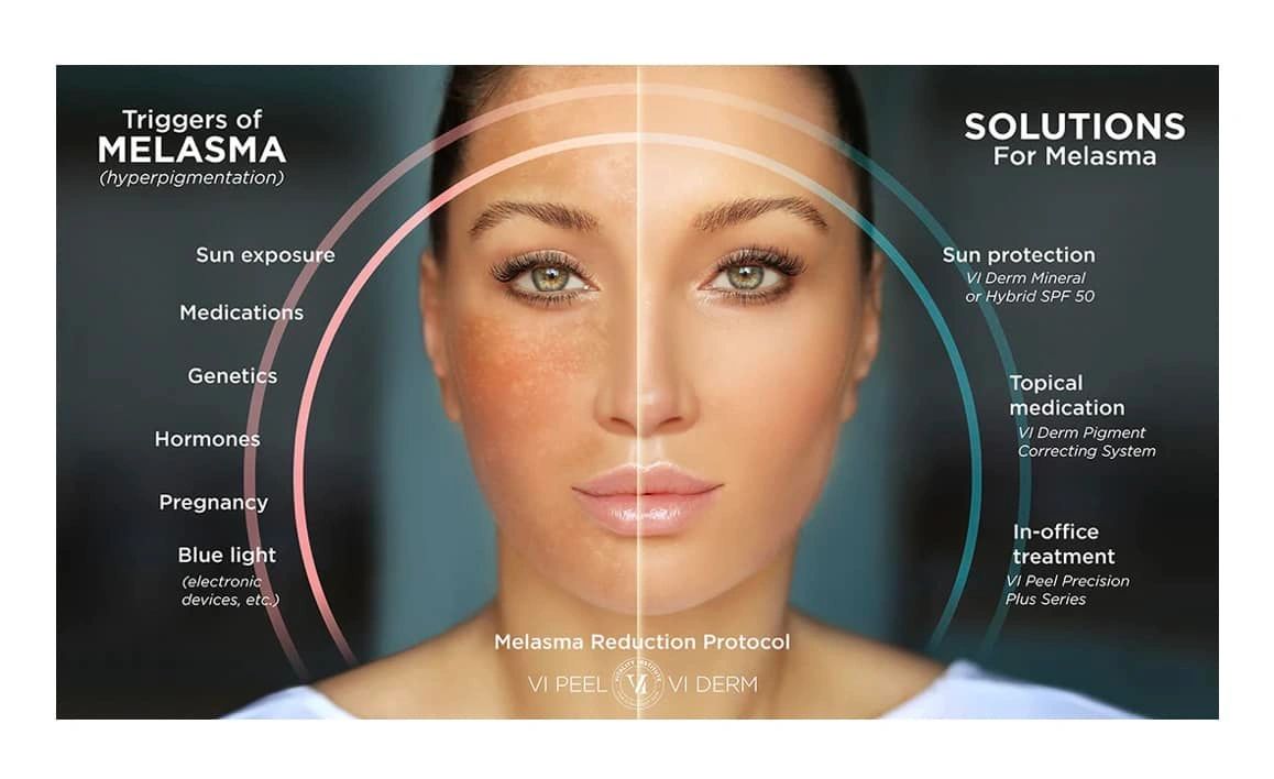 Skincare Treatment for Melasma: A Comprehensive Guide