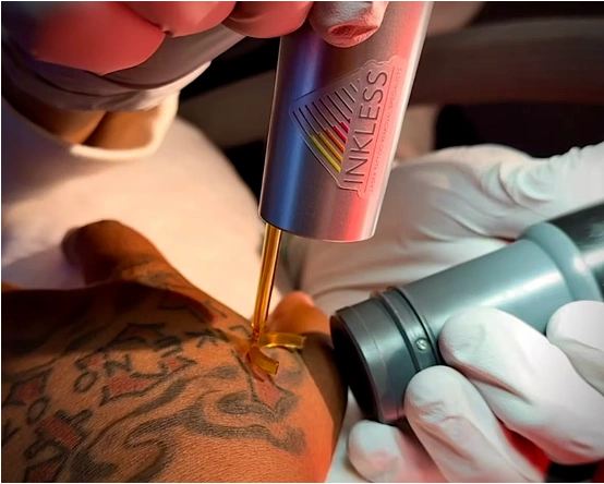 Sin Tinta - InkLESS Tattoo Removal