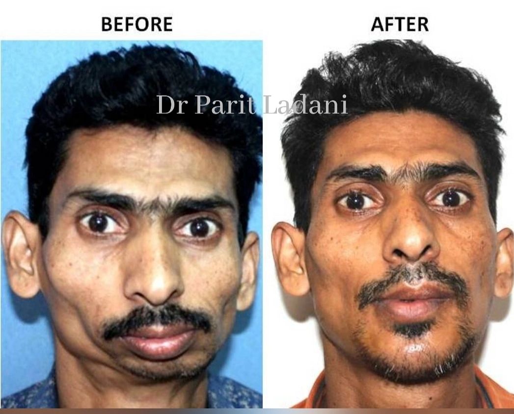 Asymmetrical Face Surgery Before And After
