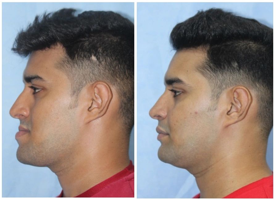 Double Jaw Surgery in India: Best Orthognathic Surgeon in India