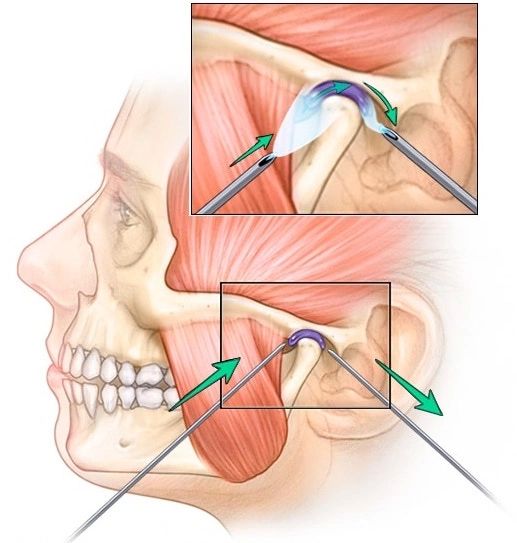 Temporomandibular Joint Arthrocentesis Treatment : Expert Advise