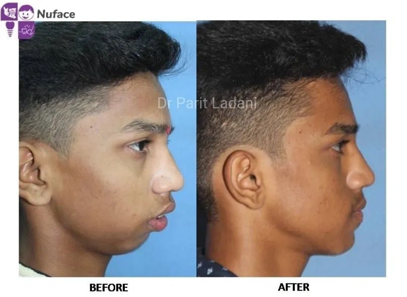 Surgery-First Corrective Jaw Surgery in Mumbai: A Complete Guide
