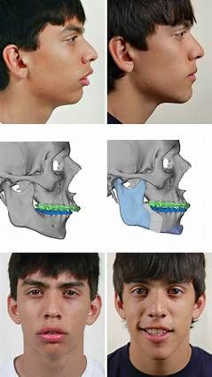 Does Overbite Correction Require Surgery A Comprehensive Guide