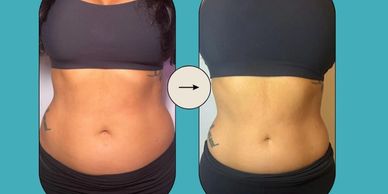 GLOW - Microneedling Facial, Advance Skincare, Microneedling Facial ...