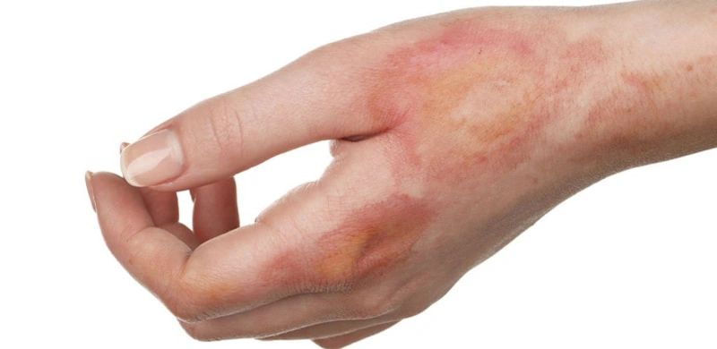 Quemaduras Electricas Mano