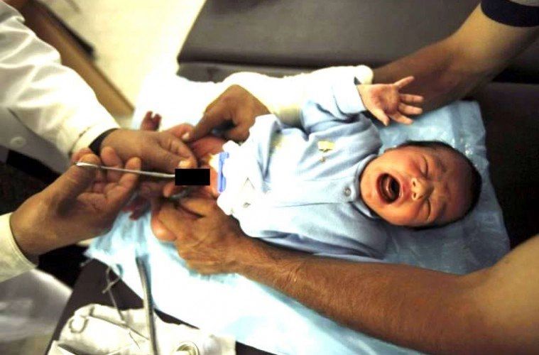Horrifying Facts of Circumcision