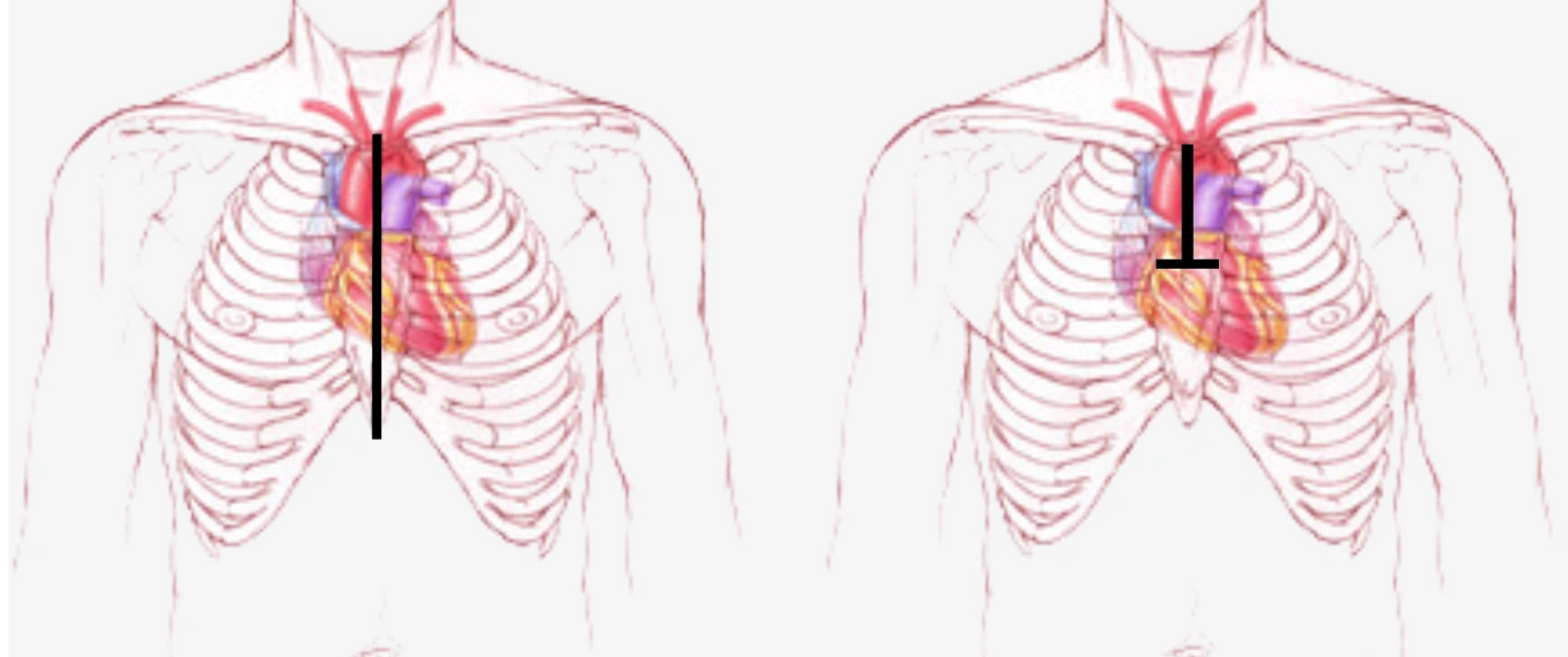 Mini-Sternotomy | Minimally Invasive Heart