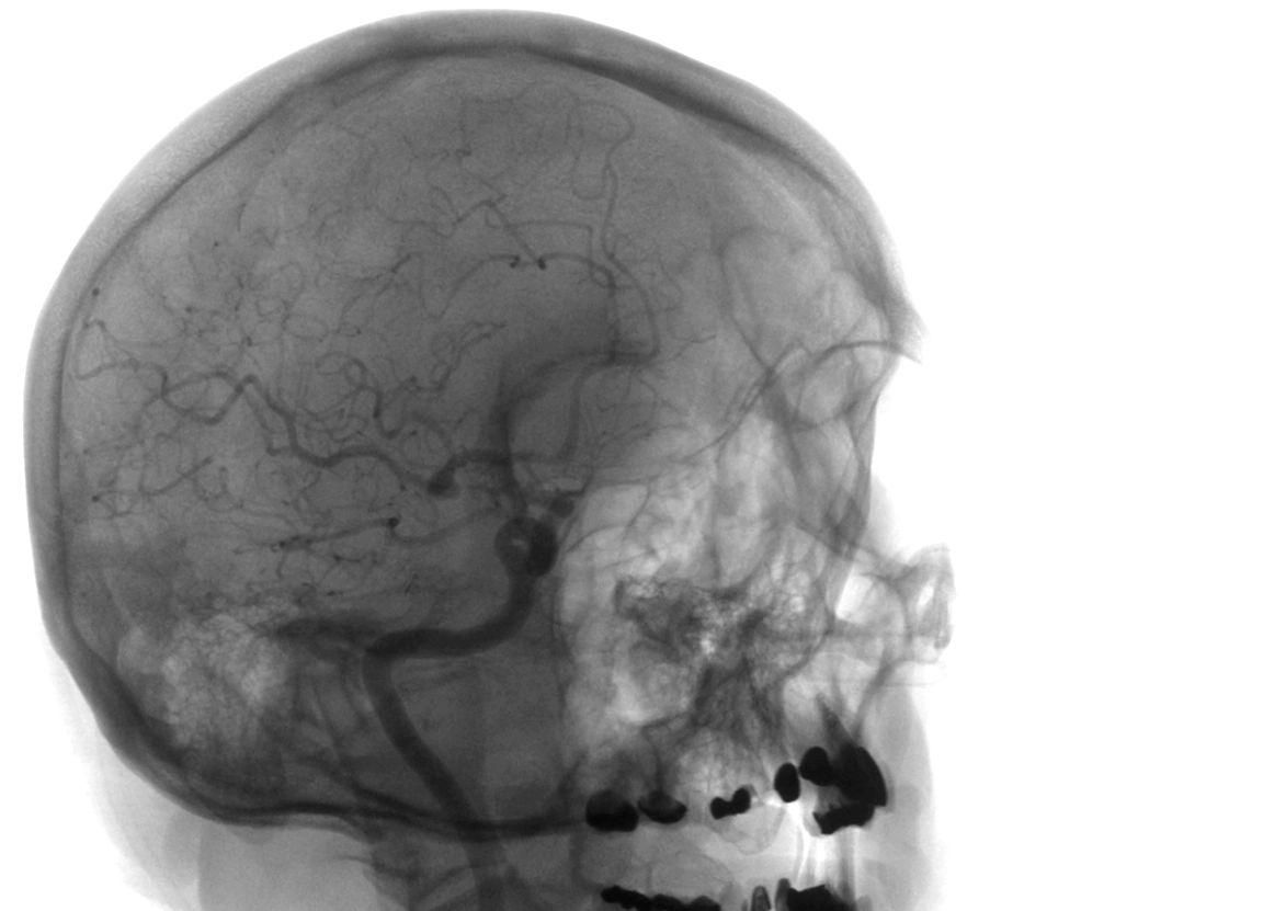 Tumor embolization