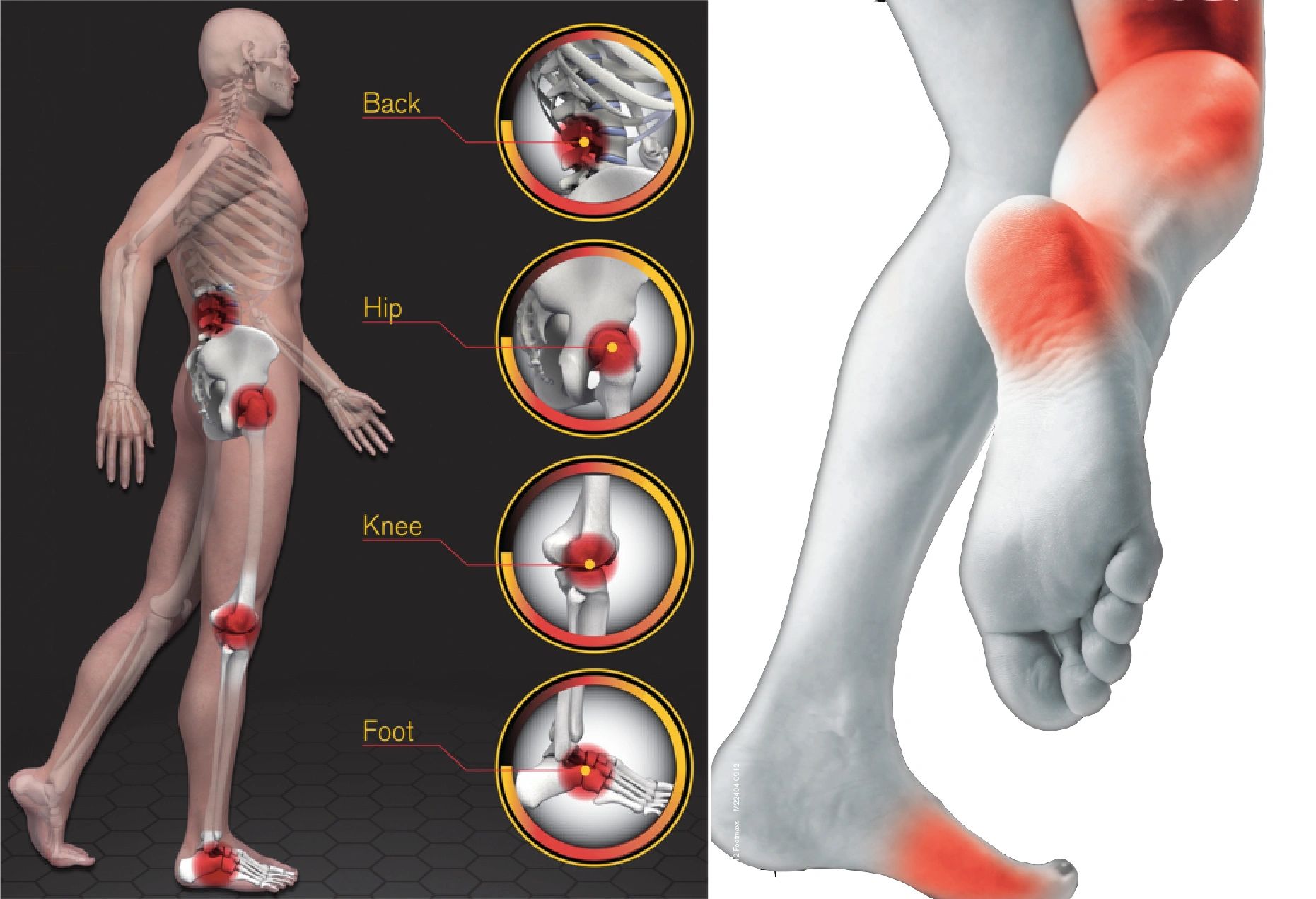 Dropped Metatarsal Head