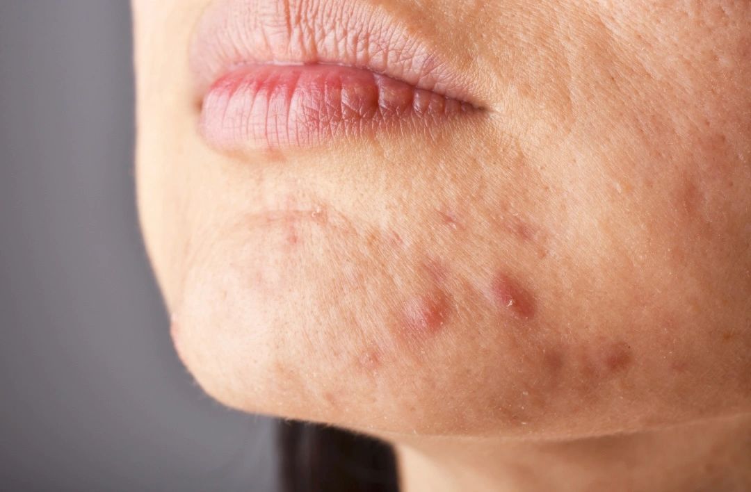 Understanding Skin Purging: A Guide to Managing the Process