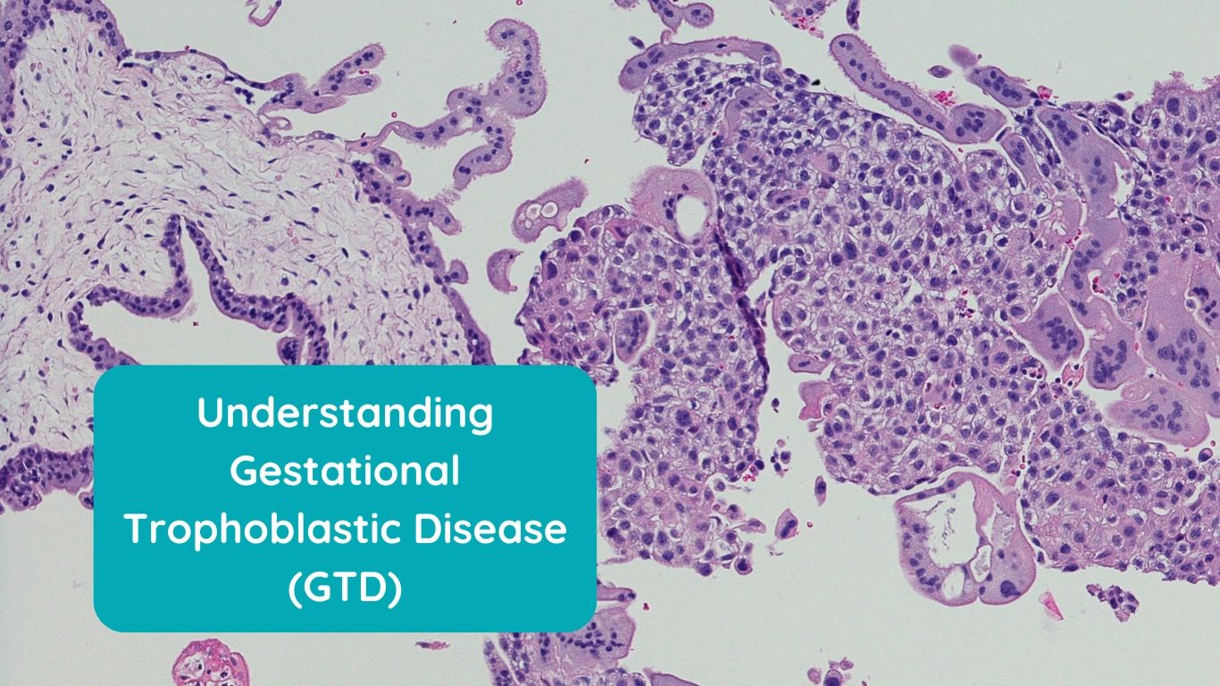 Understanding Gestational Trophoblastic Disease (GTD)