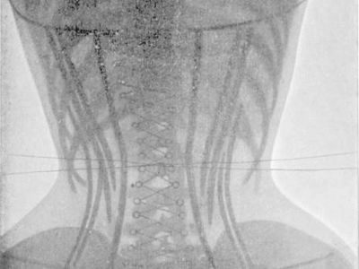 Corsets and Health
