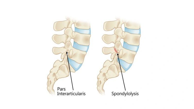 Spondylosis Dengan Akupunktur