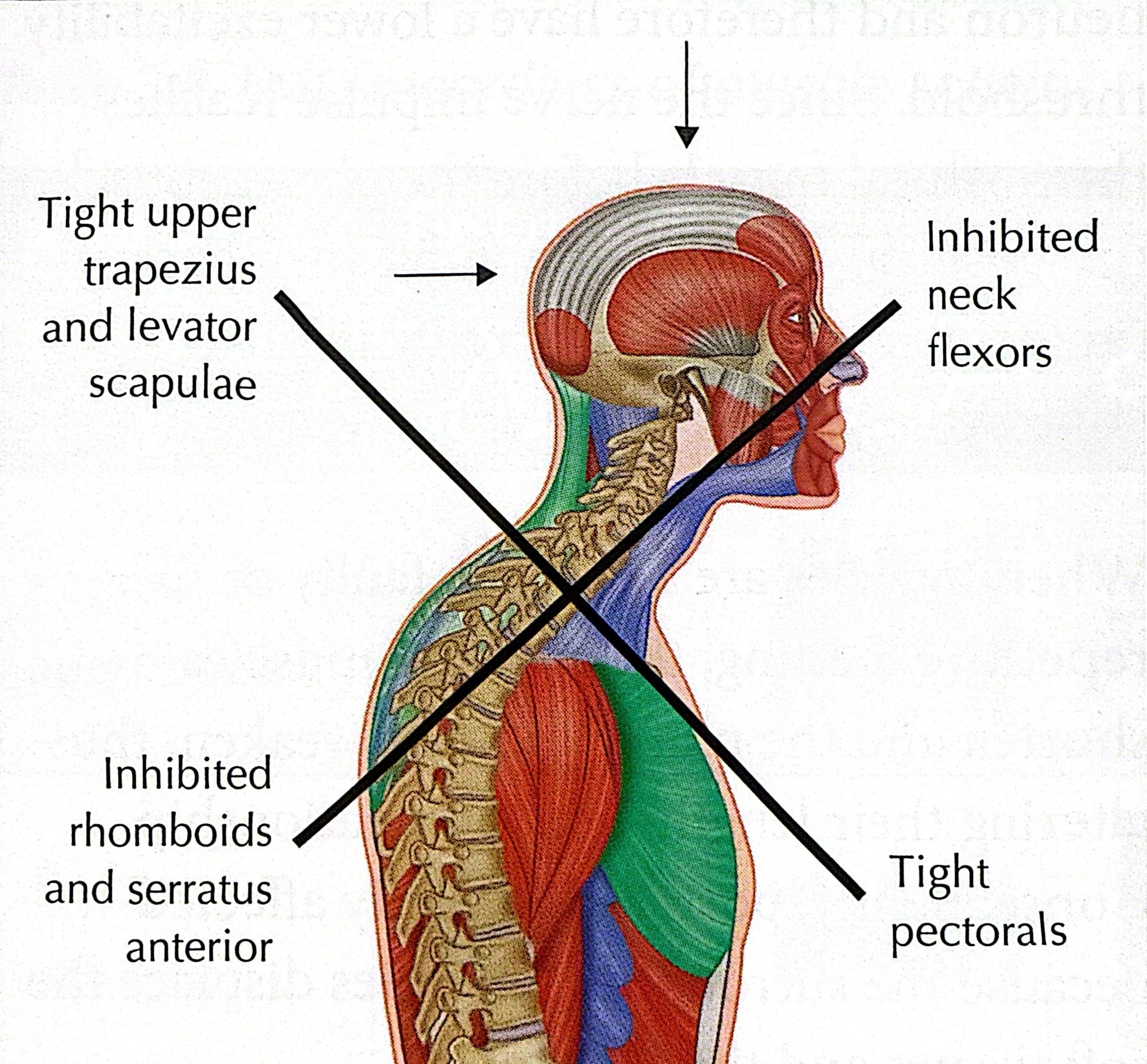 Understanding Upper Crossed Syndrome (UCS)