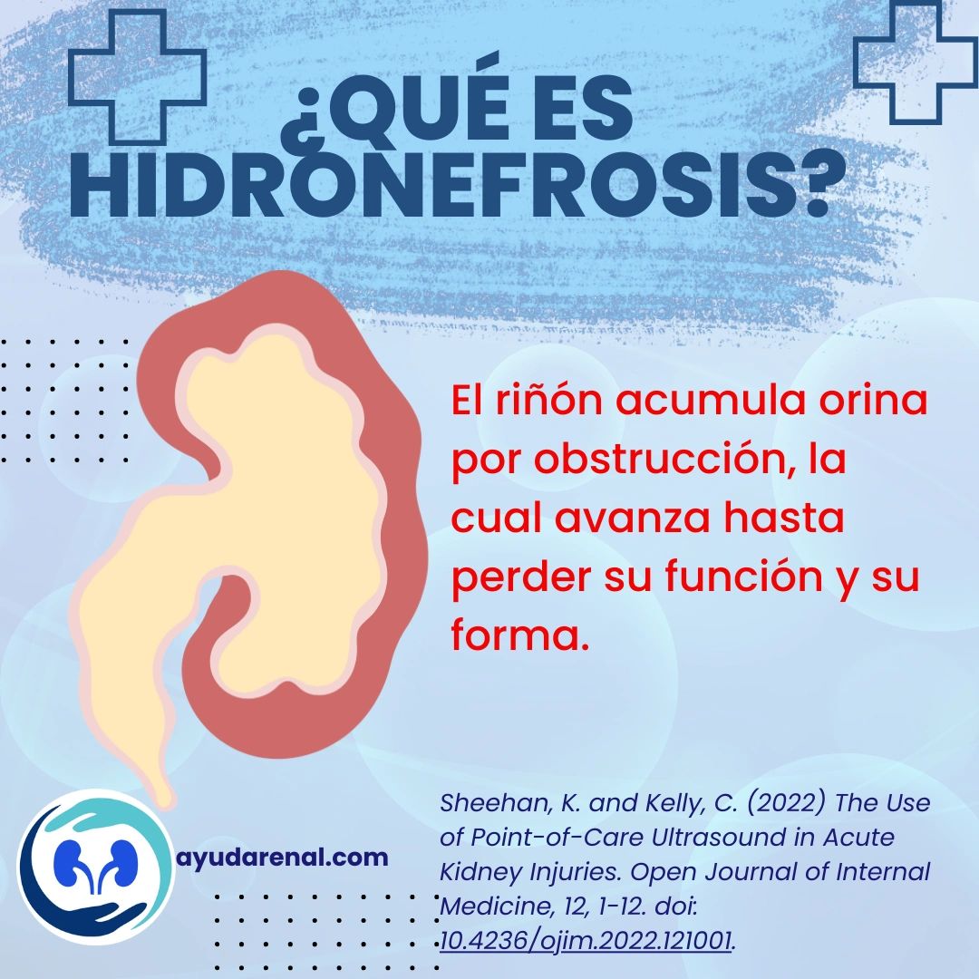 ¿Qué es hidronefrosis?