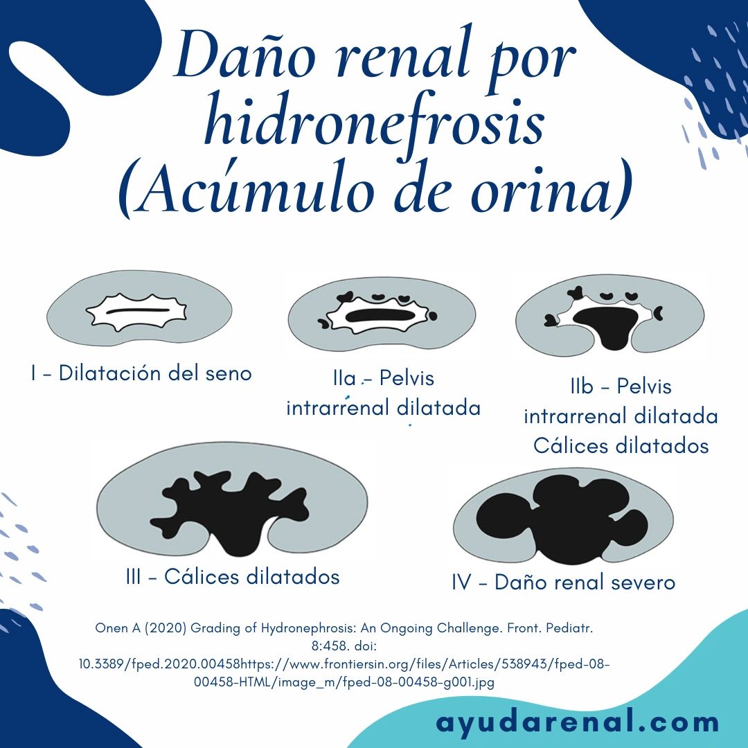Hidronefrosis (Acúmulo de orina)