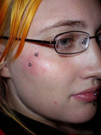 Dermal Piercing Scars
