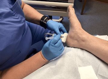 Platelet Rich Plasma Injections for Plantar Fasciitis