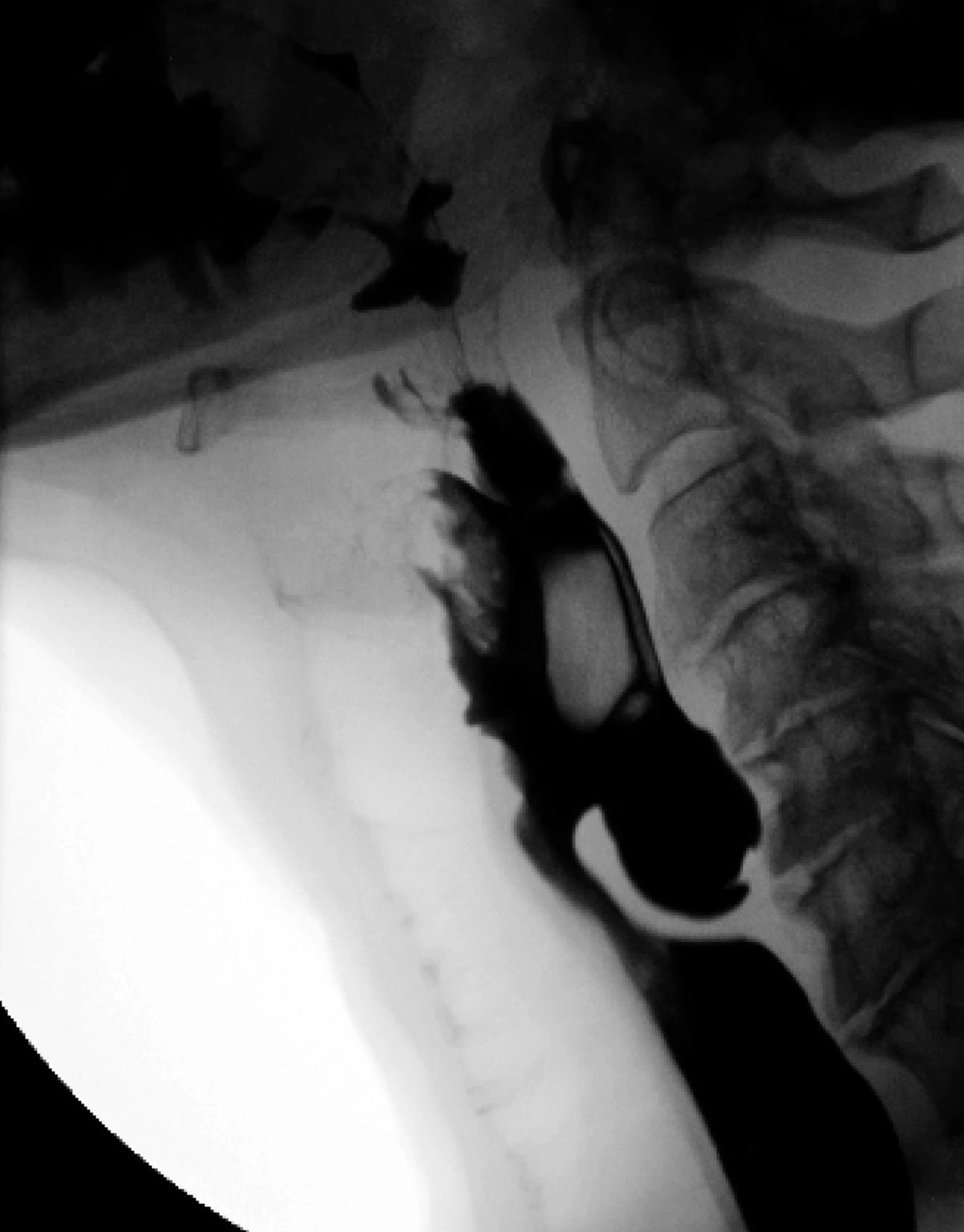 Zenker's Diverticulum