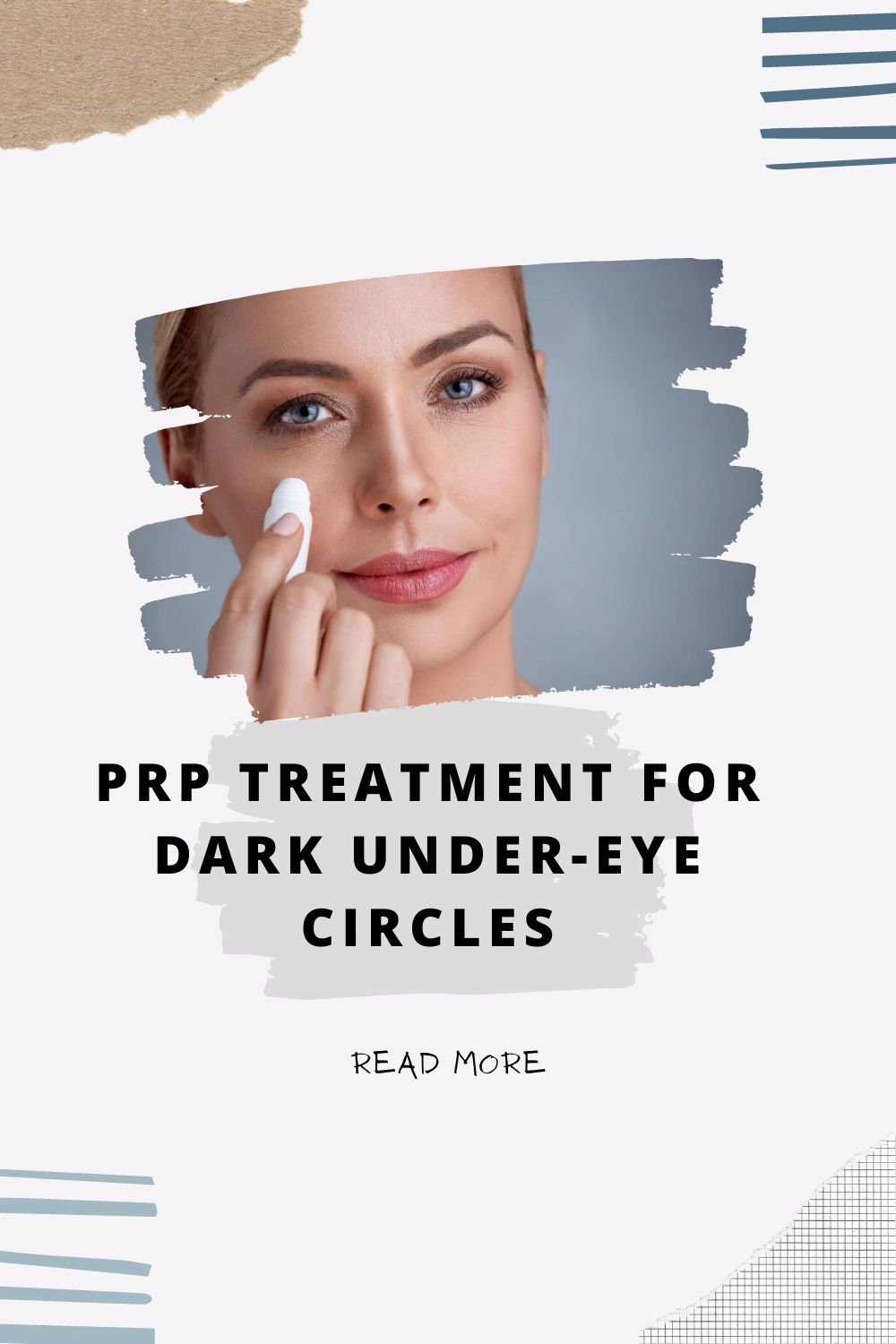PRP treatment for dark under-eye circles