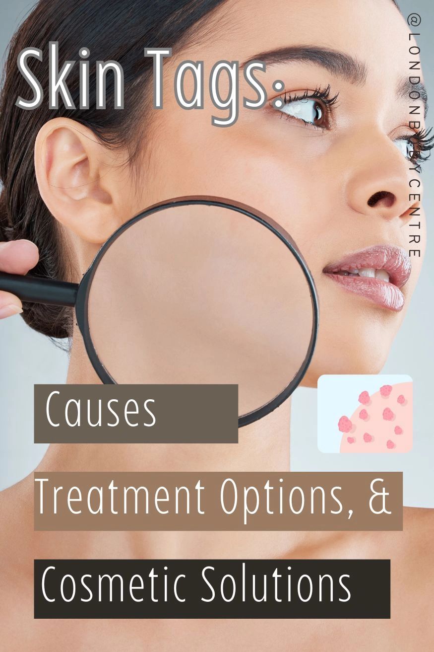 Skin Tags; Causes, Treatment Options, and Cosmetic Solutions