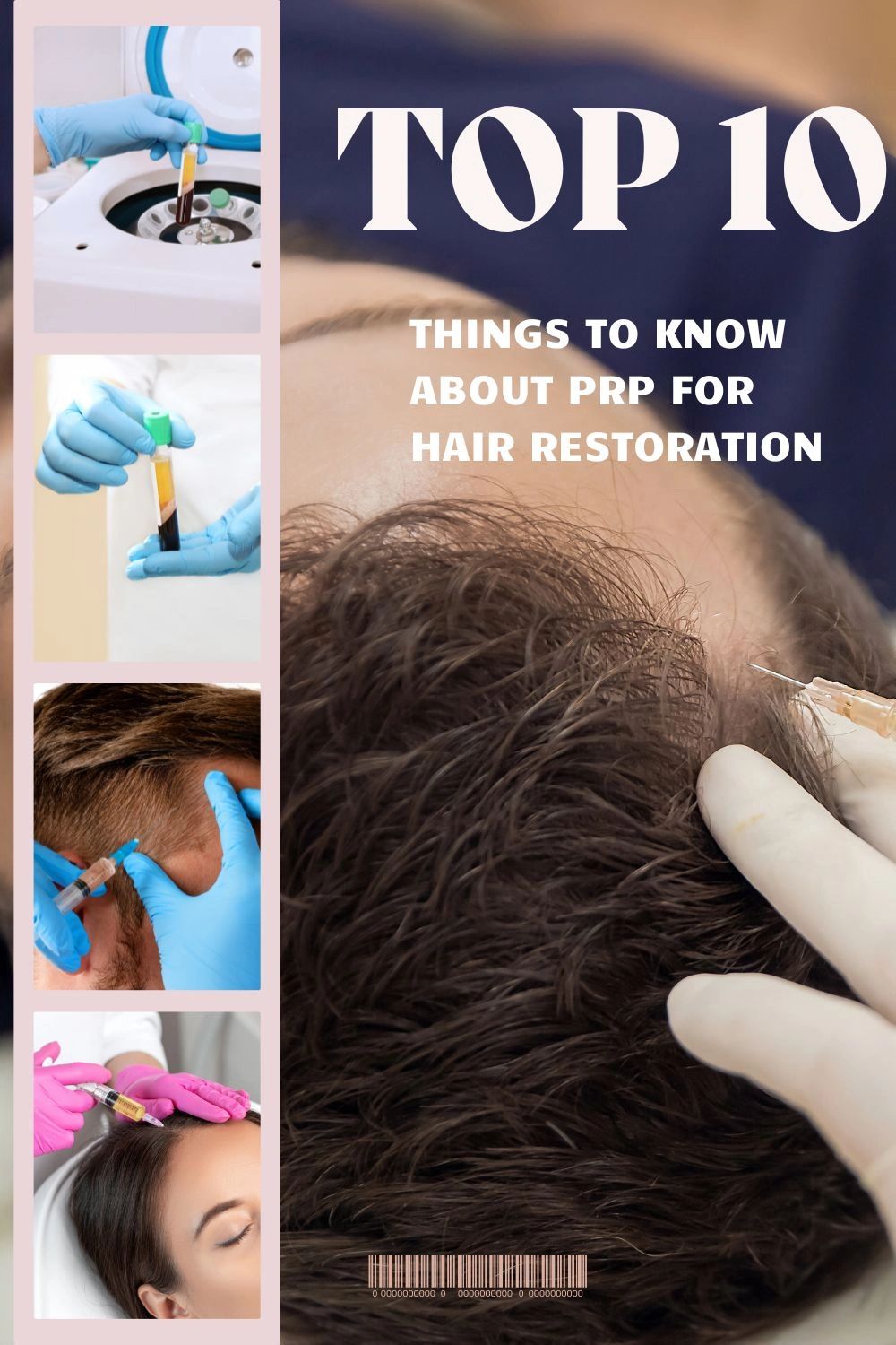 Top 10 things to know about prp for hair restoration