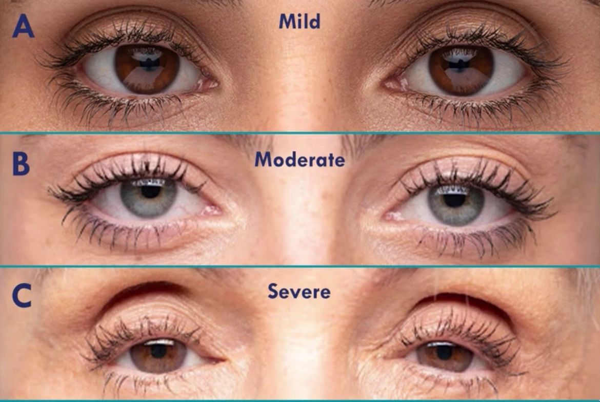 UPNEEQ for Low-Lying Lids